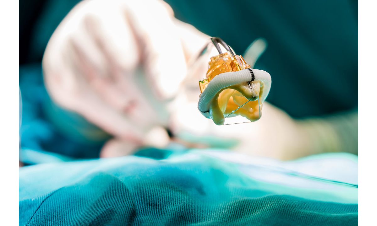 Cardiovascular & Blood Flow Simulation Software | Ansys