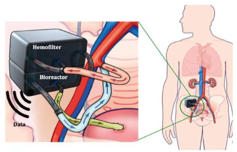 Artificial Kidney Diagram