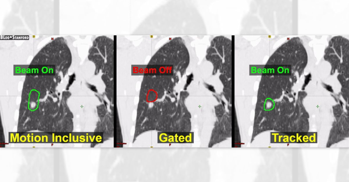 Targeting Cancer in a Flash with Simulation, Radio Frequency, and ...